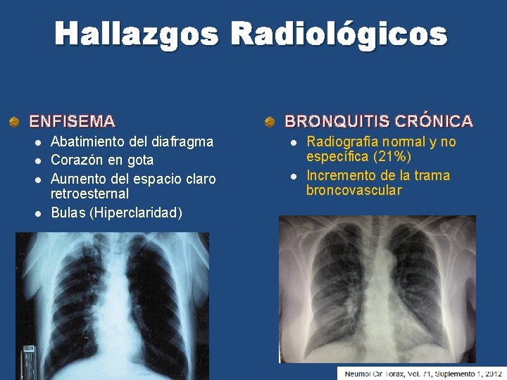 ENFERMEDAD PULMONAR OBSTRUCTIVA CRNICA EPOC Marco Antonio Morales