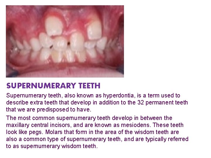 Developmental disturbances affecting size and number of teeth