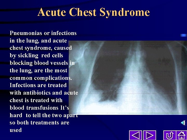 What is Sickle Cell Disease What is Sickle