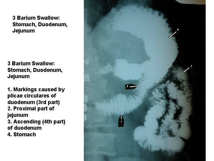 ABDOMEN AND PELVIS RADIOGRAPHS AND IMAGES XRAYS AND
