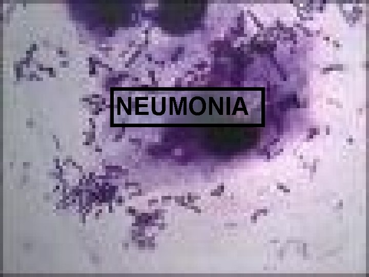NEUMONIA Neumona Definicin enfermedad inflamatoria de los pulmones