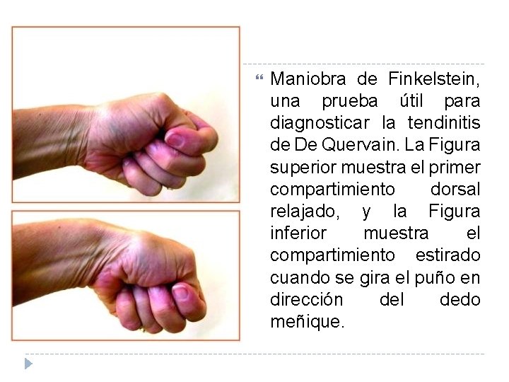 Tendinitis de De Quervain Kinesioterapia 1 Magaly Contreras