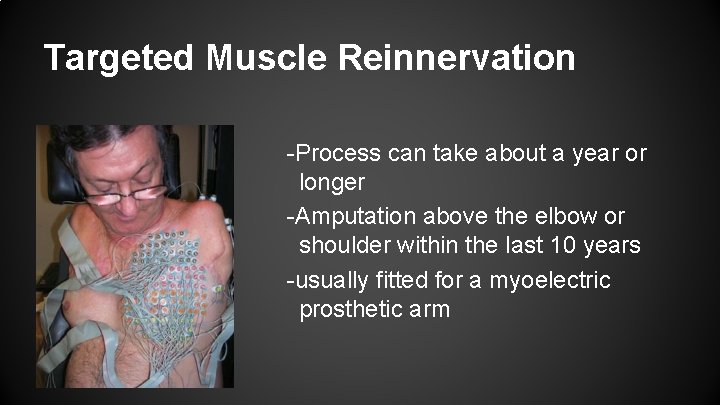 The Evolution of Robotic Prosthetics Sam Hammock Nick