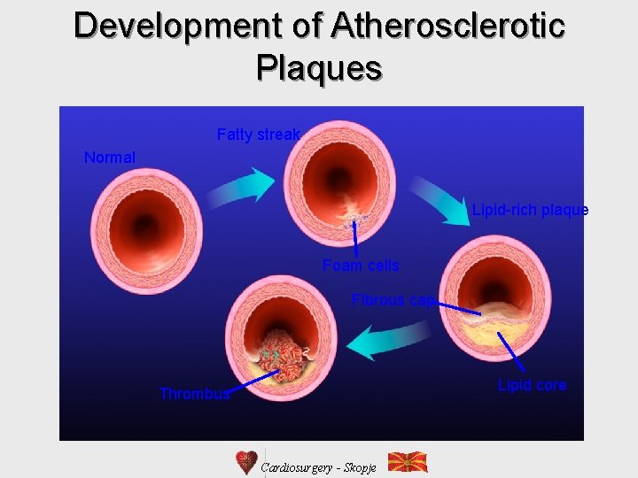 Differential diagnosis and treatment of acute coronary disease