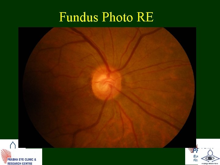 NEOVASCULAR GLAUCOMA Dr Gowri J Murthy DNB FRCO