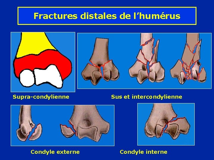 Fractures du COUDE Fractures distales de lhumrus Supracondylienne