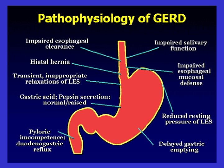 Gastroesophageal Reflux Disease GERD Dr SAPTINO MIRO Sp