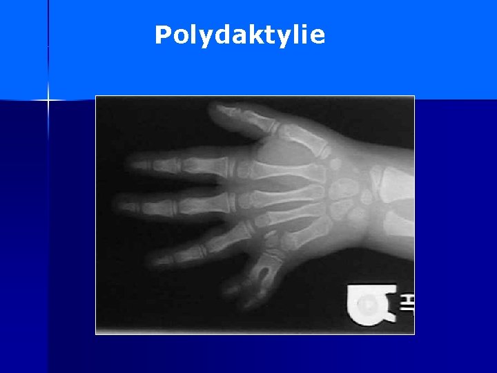 Zpst a ruka Rozkydal Z Nachtnebl L Bartes