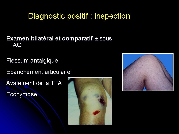 Entorse et luxation de genou Epidmiologie l l