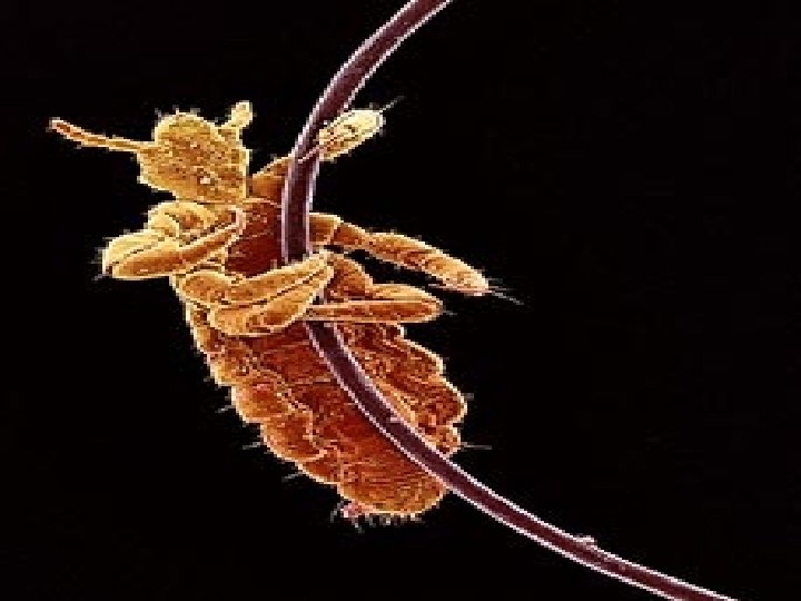 QU ES LA PEDICULOSIS La pediculosis es una