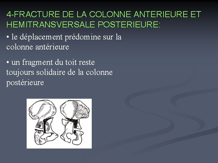 LES FRACTURES DU COTYLE CE QUATTEND LE CHIRURGIEN