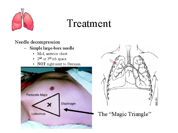 Penetrating Chest Wounds Pneumothorax Tension Pneumothorax and Hemothorax