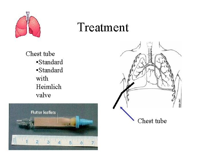 Penetrating Chest Wounds Pneumothorax Tension Pneumothorax and Hemothorax