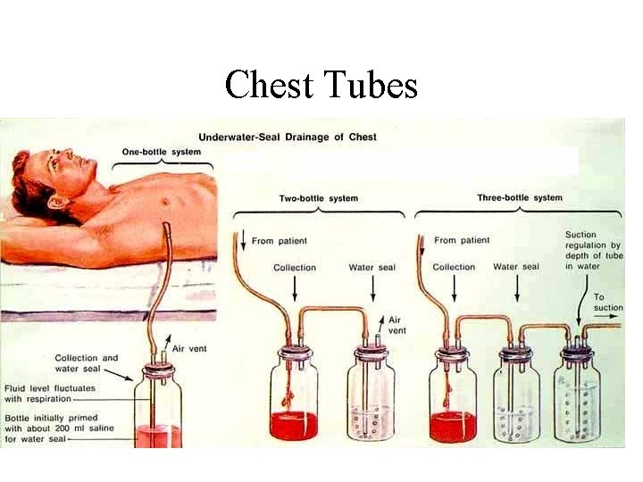 Penetrating Chest Wounds Pneumothorax Tension Pneumothorax and Hemothorax