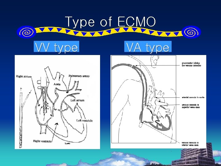 ECMO Extra Corporeal Membrane Oxygenator 2007 9 18