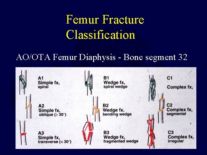 Femoral Shaft Fractures Robert F Ostrum MD Cooper