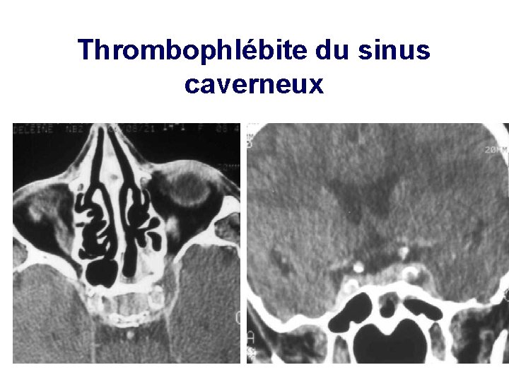 THROMBOSES VEINEUSES CEREBRALES Serge BRACARD 2009 1 Plan