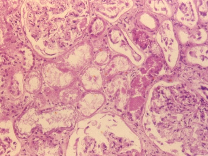 TUBULOINTERSTITIAL DISEASES Terminology u Tubulointerstitial nephritis ...