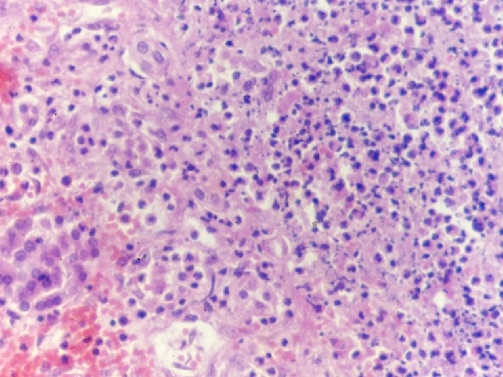 TUBULOINTERSTITIAL DISEASES Terminology u Tubulointerstitial nephritis ...