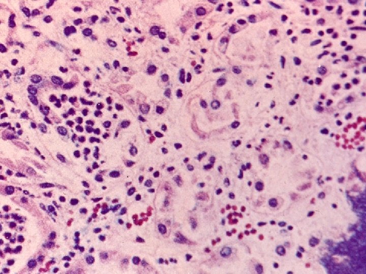 TUBULOINTERSTITIAL DISEASES Terminology u Tubulointerstitial nephritis ...