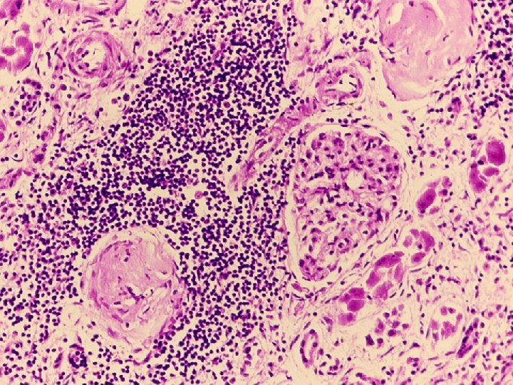 TUBULOINTERSTITIAL DISEASES Terminology u Tubulointerstitial nephritis ...