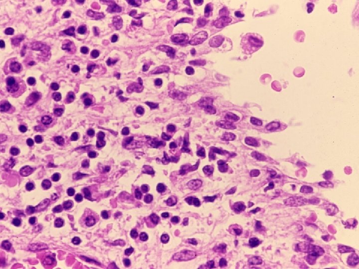 TUBULOINTERSTITIAL DISEASES Terminology u Tubulointerstitial nephritis ...