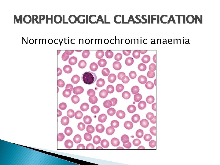 ANEMIA DEFINITION CLASSIFICATION Maj Gen R Masood Anwar