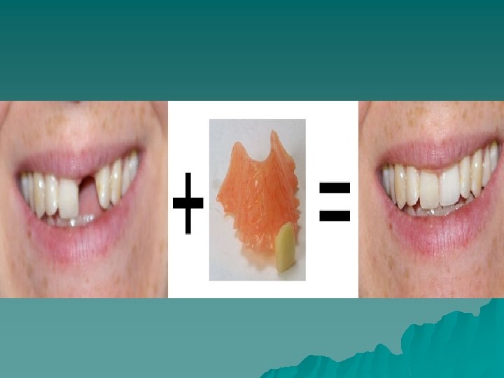 Acrylic Dentures Dr Nesreen Salim CoCr Partial denture