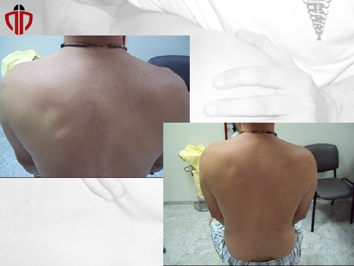 Impingement fenomen ramena drugaiji pogled na fizioterapiju Dean