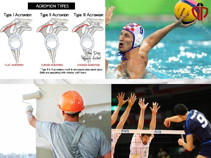Impingement fenomen ramena drugaiji pogled na fizioterapiju Dean