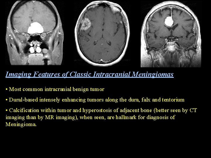 Patient with Intracranial mass Q 1 Diagnosis Please