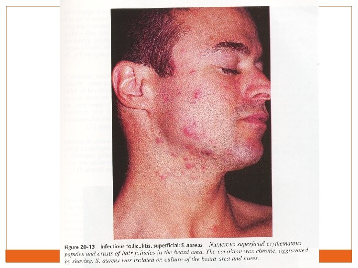 PIODERMA dr Gardenia Akhyar Sp KK PIODERMA Definisi