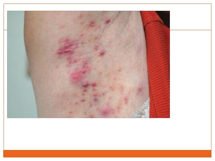 PIODERMA dr Gardenia Akhyar Sp KK PIODERMA Definisi