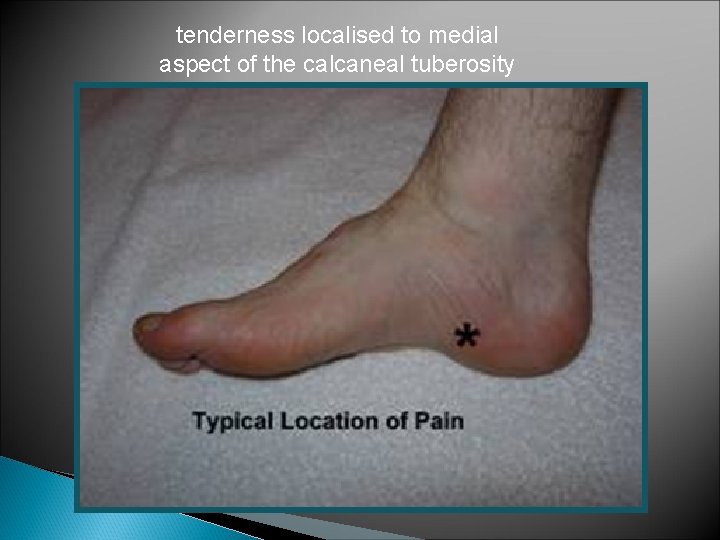 Heel pain Plantar Fasciitis Dr Isstelle Joubert May