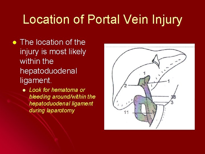 Extrahepatic Biliary and Vascular Injuries Niqui Kiffin MD
