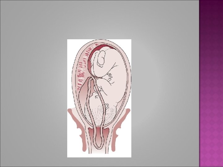 Cord presentation This occurs when the umbilical cord