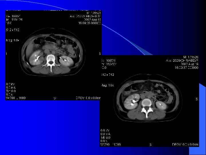 Spaiul retroperitoneal anatomie imagistic Spaiul retroperitoneal l Limite