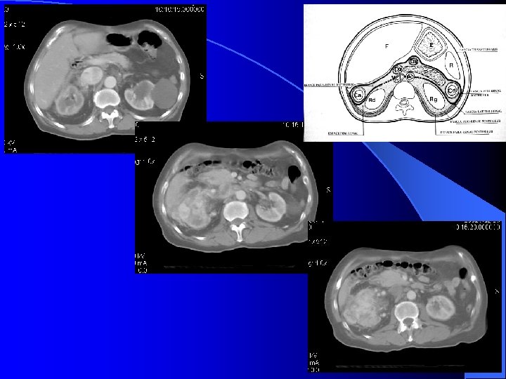 Spaiul retroperitoneal anatomie imagistic Spaiul retroperitoneal l Limite