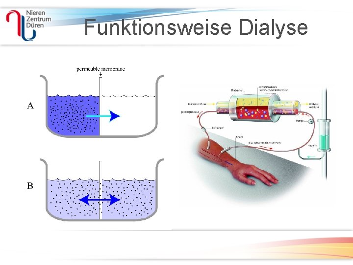 Dialysepflichtige Patienten was ist rund um die Operation