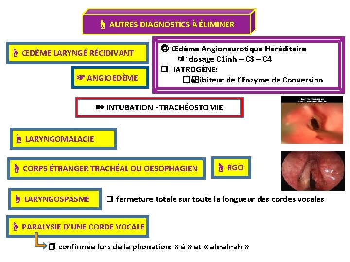 SYNDROME DE DYSFONCTION DYSKINSIEDES CORDES VOCALES DYSKINSIE LARYNGE