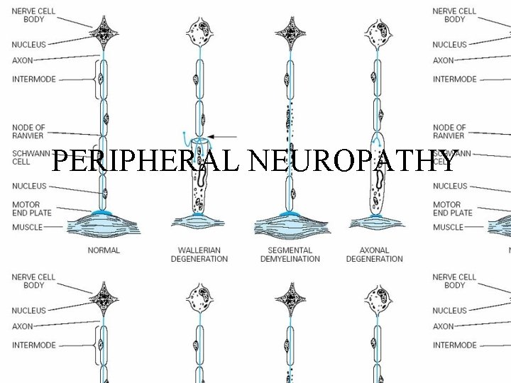 PERIPHERAL NEUROPATHY PHYSIOLOGY Pain and temperature sensation ...