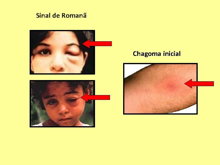 Trypanosoma cruzi e Doena de Chagas Agente Etiolgico