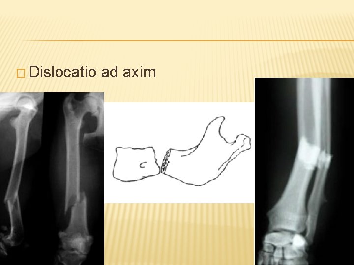 ZLOMENINY FRACTURAE Barbora Tomov Tereza Vanurov 17 sk