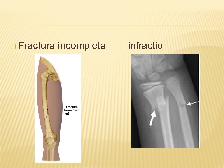 ZLOMENINY FRACTURAE Barbora Tomov Tereza Vanurov 17 sk