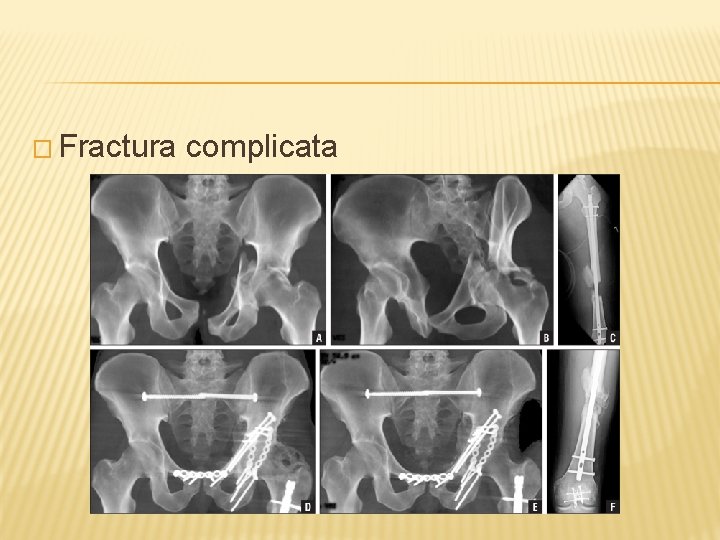 ZLOMENINY FRACTURAE Barbora Tomov Tereza Vanurov 17 sk