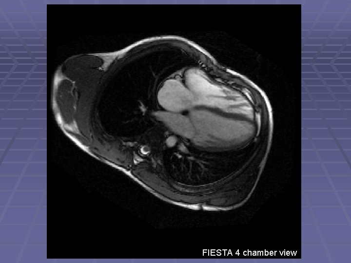Tetralogy of Fallot Jimmy Wang Childrens Memorial Hospital