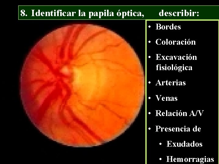 EXAMEN DEL FONDO DE OJO Exploracin bsica fundamental