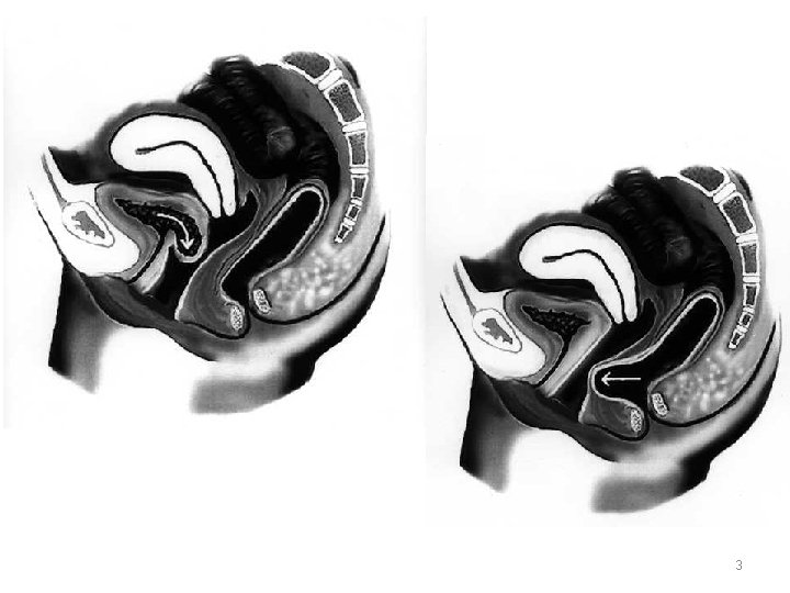 Genital Organ Displacement Practical Lesson Vaginal Wall Prolapse