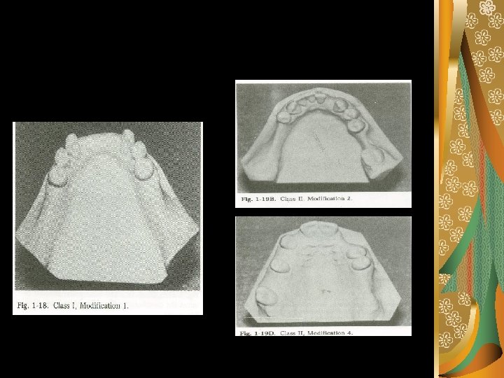 INTRODUCTION CLASSIFICATION OF RPD DEFINITION PROSTHODONTICS Defined as
