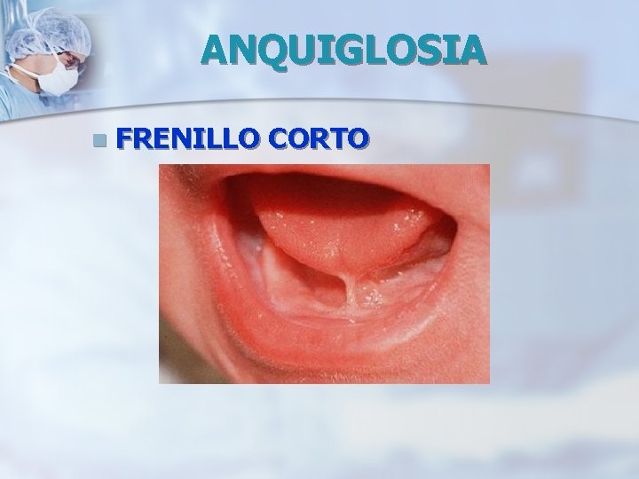 ANQUILOGLOSIA ANQUIGLOSIA DEFINICION Frenillo lingual es anormalmente corto